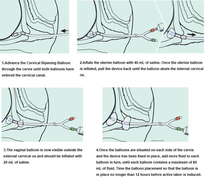 Disposable Silicone Cervical Ripening Balloon / Cervical Dilation Catheter
