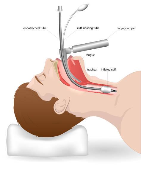Oral Or Nasal Preformed Endotracheal Tube With Cuff Or Without Cuff ...